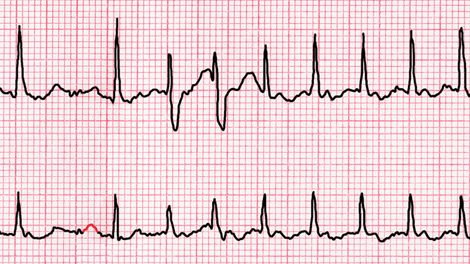 Irregular Heart Beat Graph Heart Palpitations: Should I Be Worried If