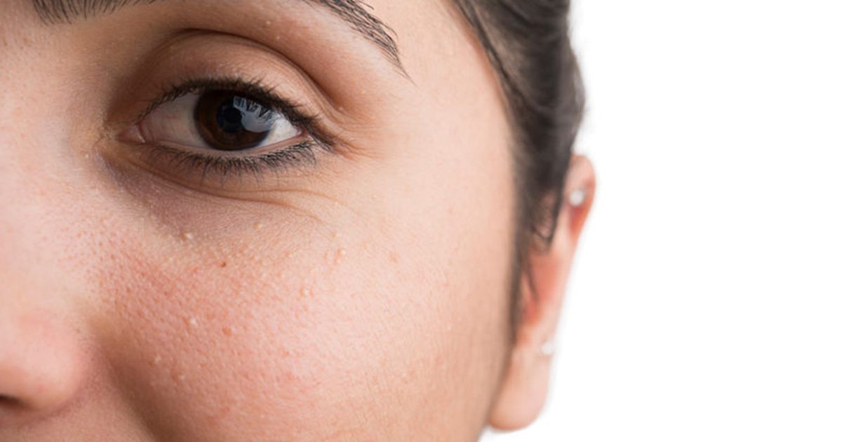 What Is Milia? Plus, The Best Milia Treatments - Chatelaine