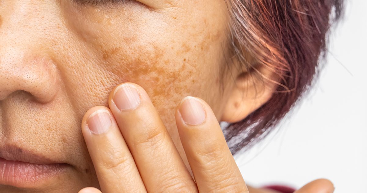 How To Treat And Prevent Hyperpigmentation - Chatelaine